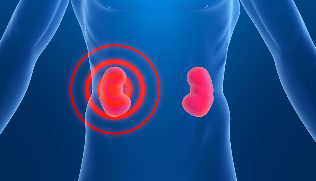 Tumore al Rene - | Prof. Laganà Urologo - Andrologo Roma